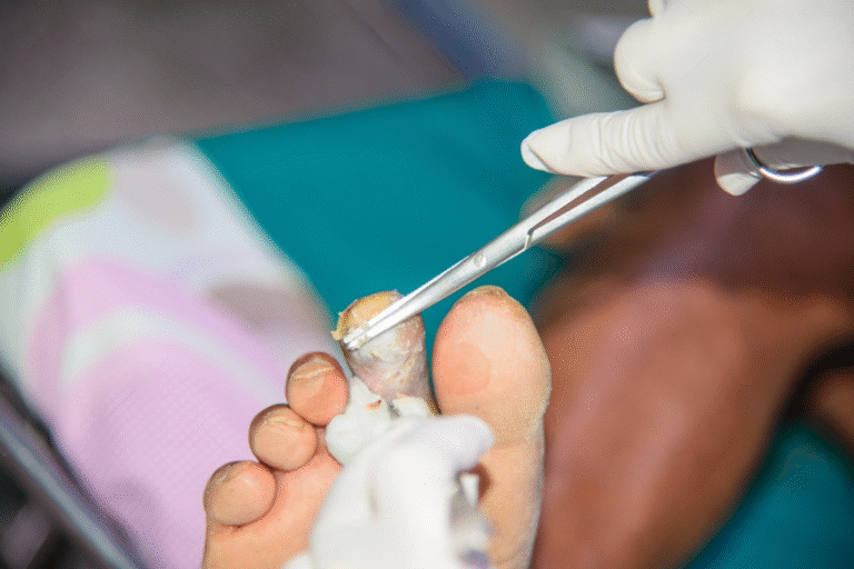 Orthopedic Treatment for Necrotic Foot: Effective Approaches to Restore ...